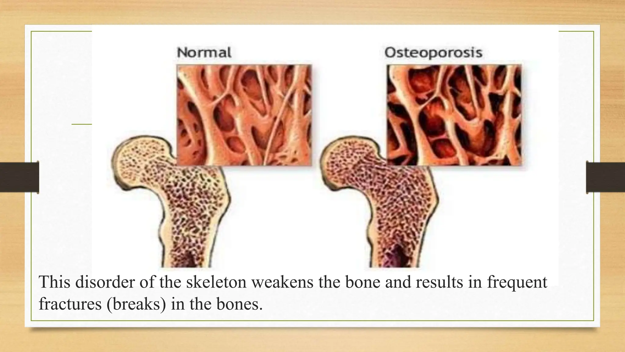 Osteoporosis Ppt For Nursing Students Pptx