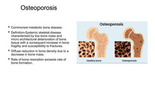Osteoporosis presentation orthopaedic ss | PPT