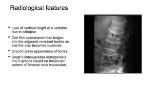 Osteoporosis presentation orthopaedic ss | PPT