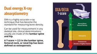 Osteoporosis - Definition , Evaluation and Management .pdf