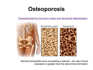 OSTEOPOROSIS lecture 1 first part of it .ppt