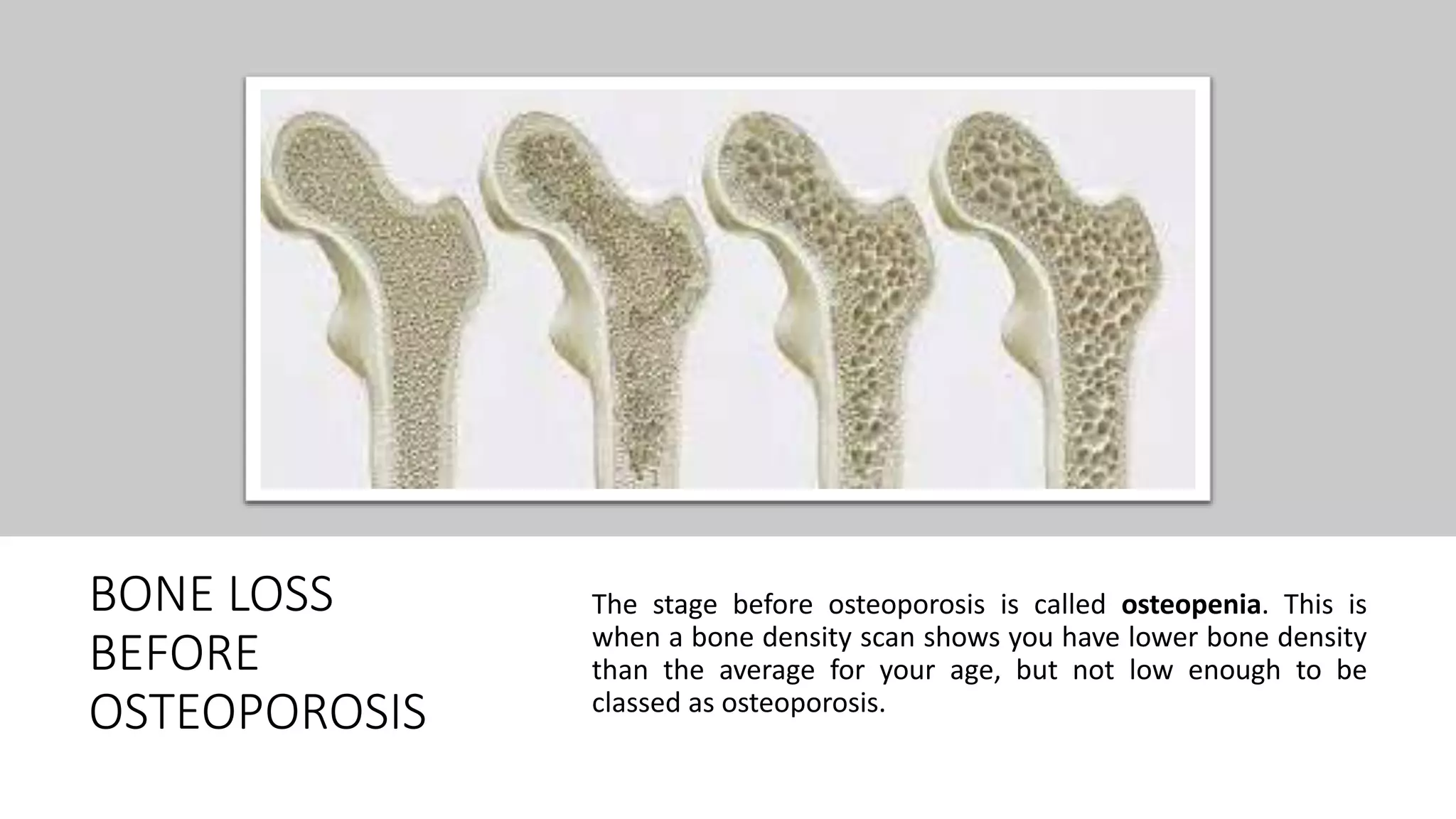 OSTEOPOROSIS-REPORT.pptx