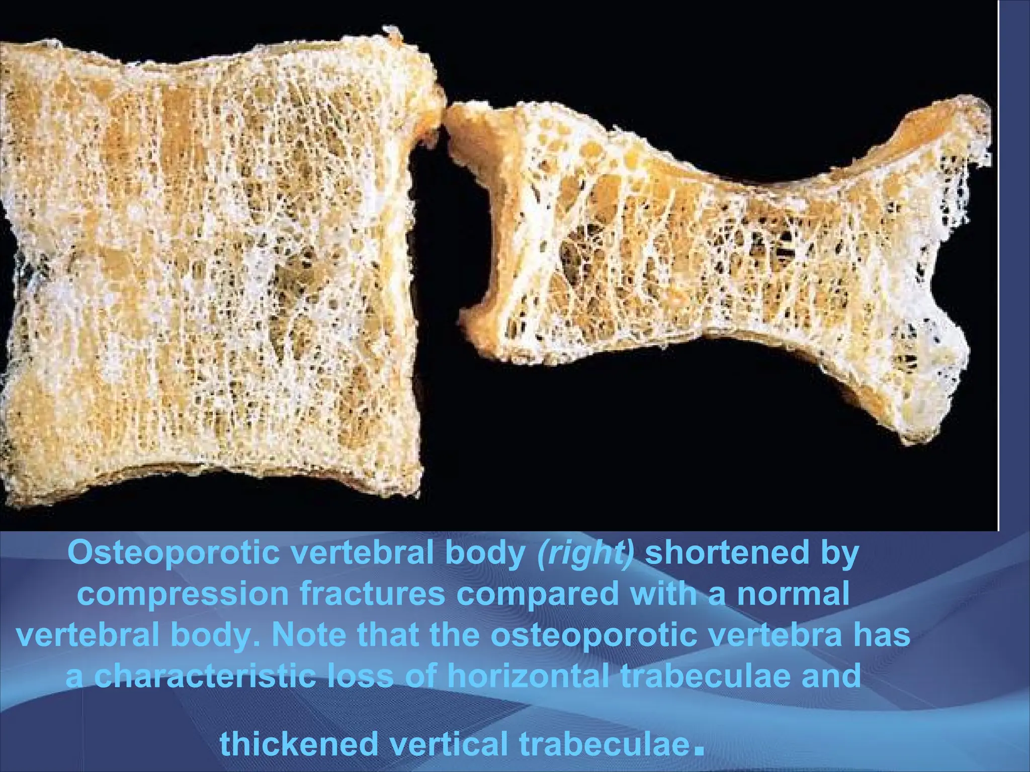 Osteoporosis Pathology Lecture 2020 MBBS | PDF