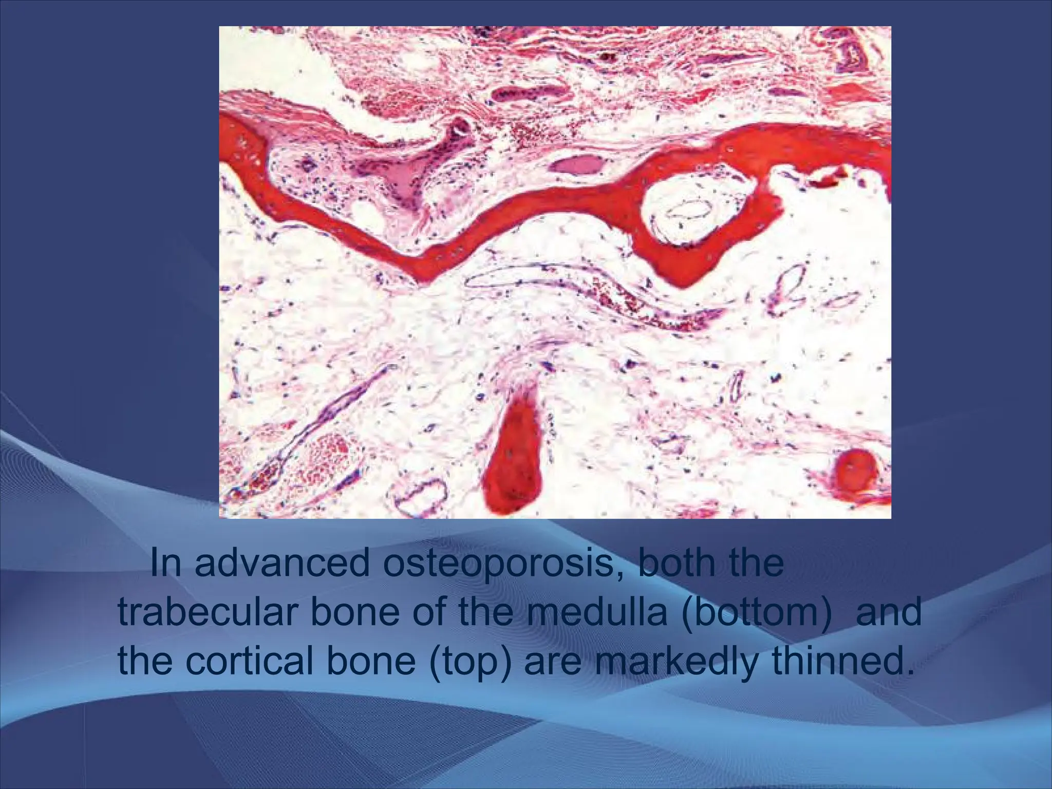 Osteoporosis Pathology Lecture 2020 MBBS | PDF