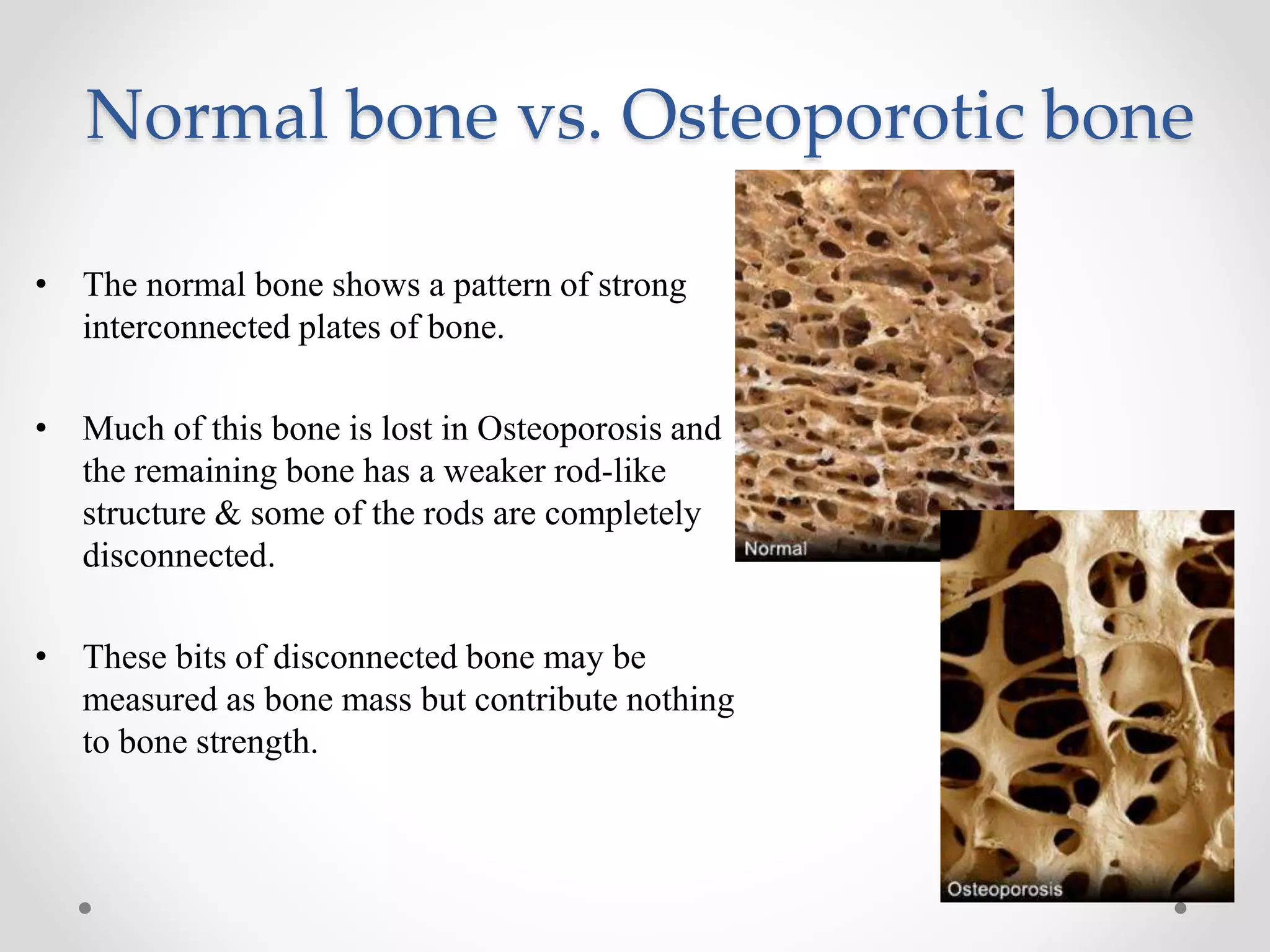 Osteoporosis Seminar | PPTX