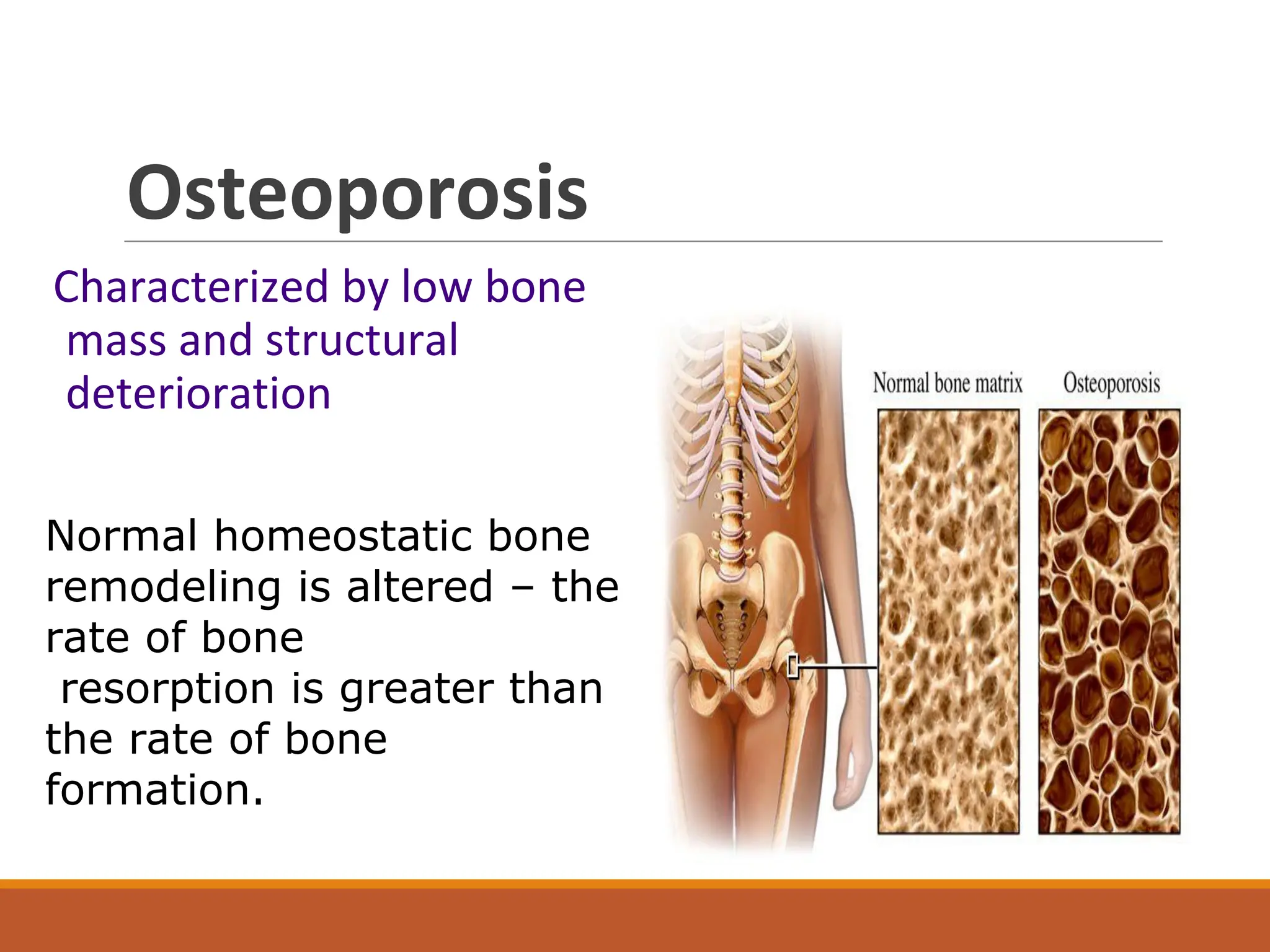 Osteoporosis and Osteomyelitis-1 institute of nursing science | PDF