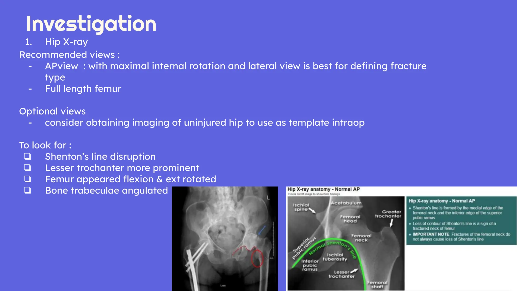 OSTEOPOROSIS & FRACTURE FRAGILITY-1.pdftvtvtvtvtv | PDF