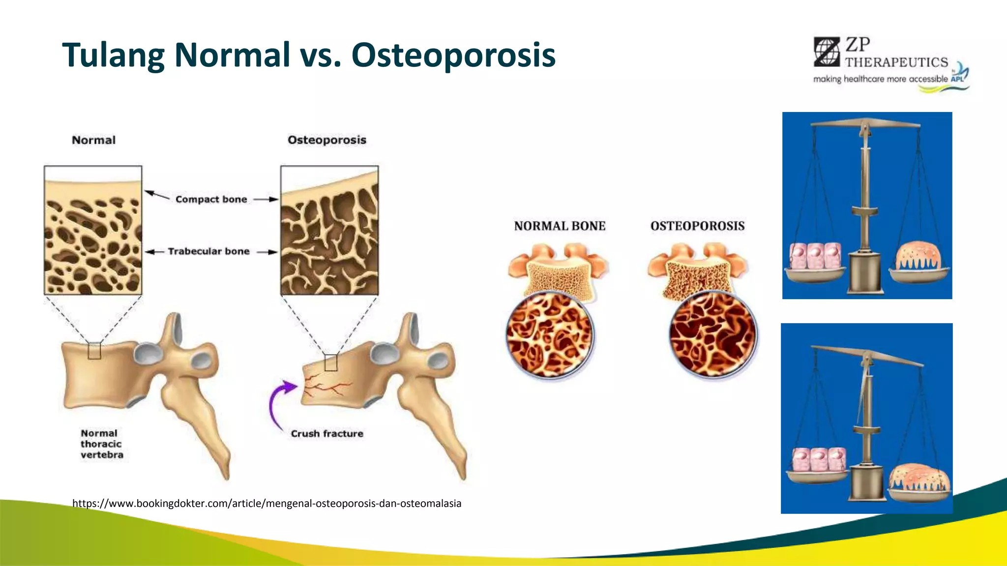 Osteoporosis, How to diagnose and treat _ Oral and Infusion Treatment.pptx