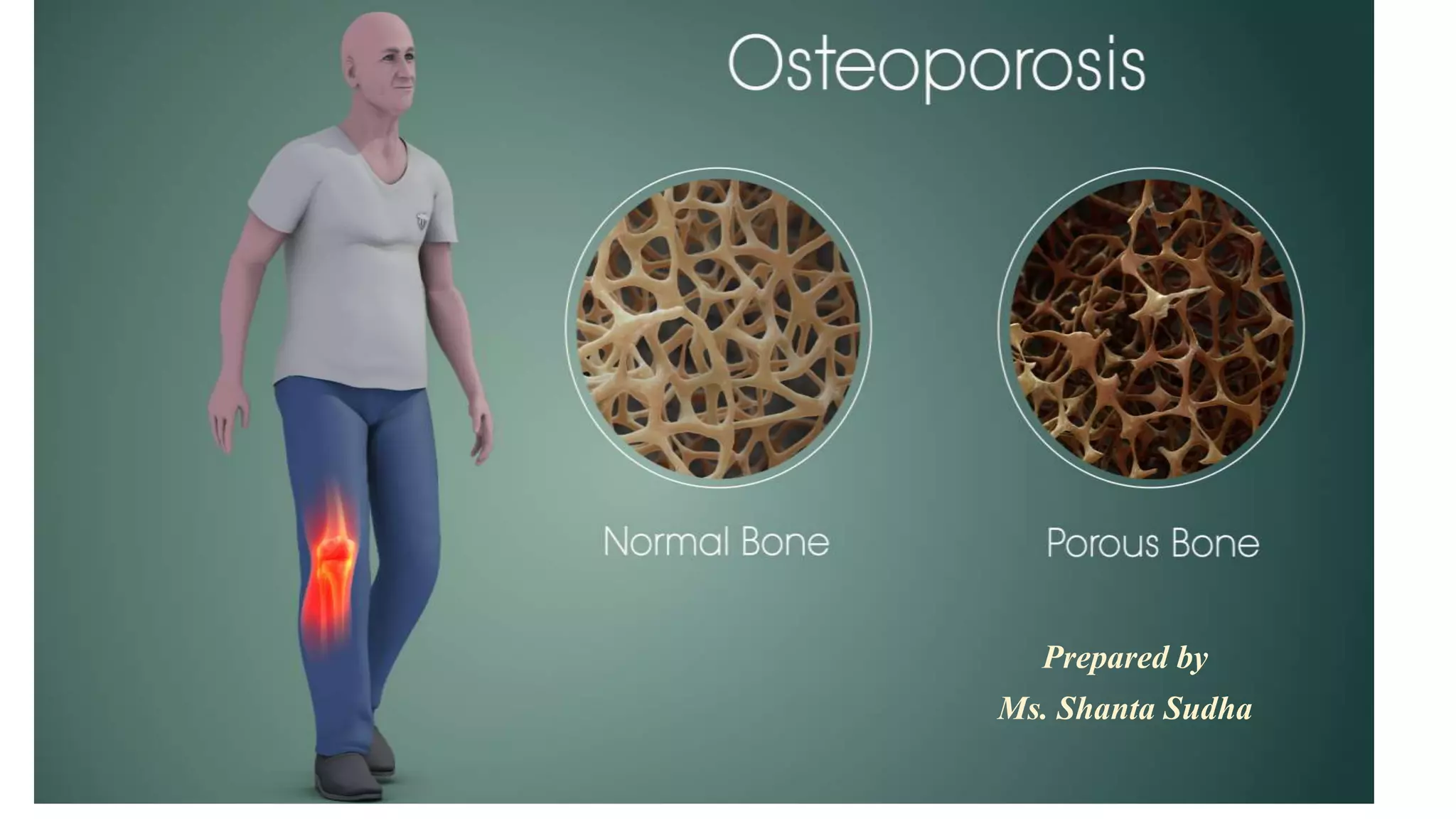 Osteoporosis & osteoarthritis | PPTX