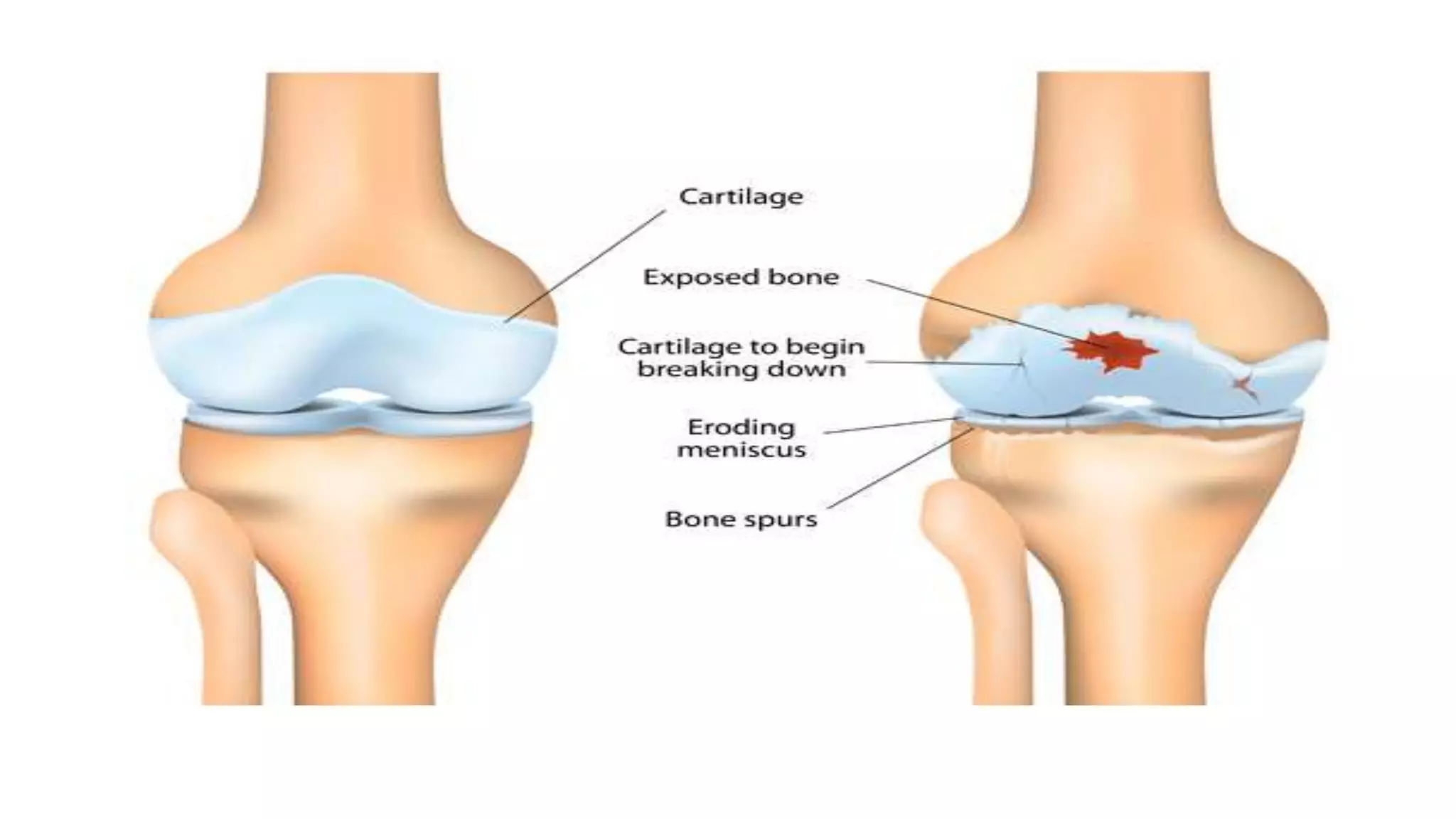 Osteoporosis & osteoarthritis | PPTX