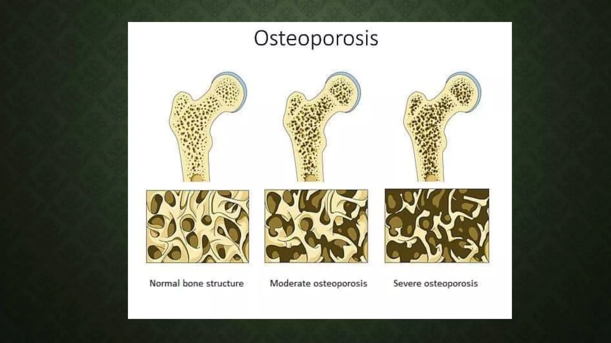 Osteoporosis | PDF