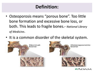 Osteoporosis Presentation.pptx