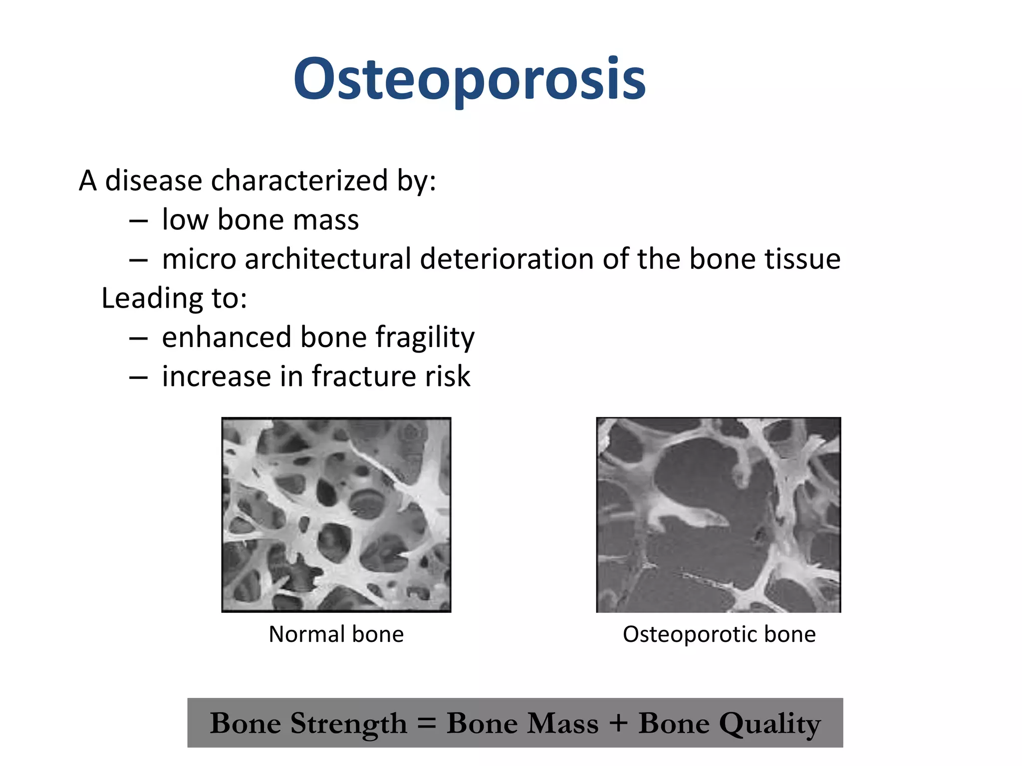 Osteoporosis seminar final.pptx