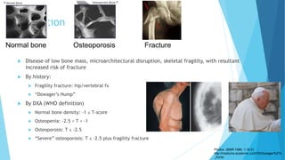 Osteoporosis updates 20190328 | PPTX