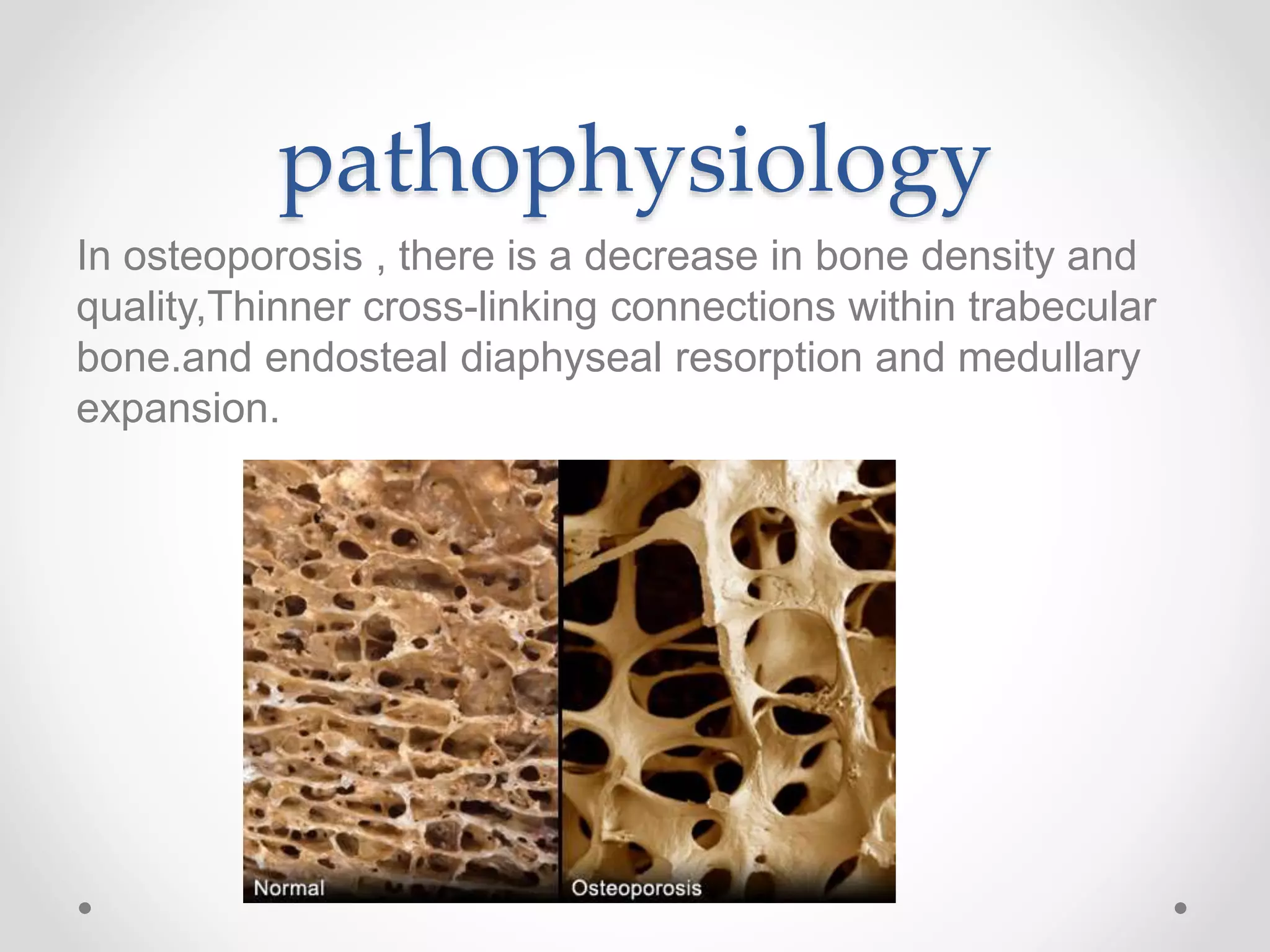 osteoporotic bone fractures .pptx