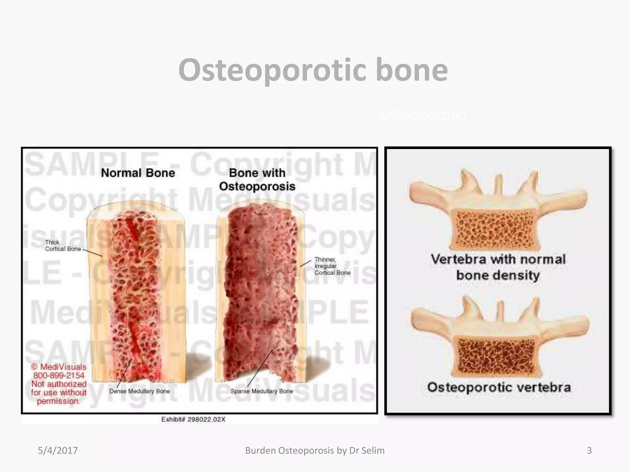 Osteoprosis: Evaluation, Management and Prevention by Dr Shahjada Selim ...