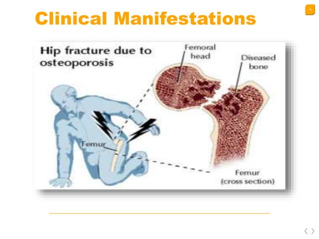Osteoporosis Management | PPTX