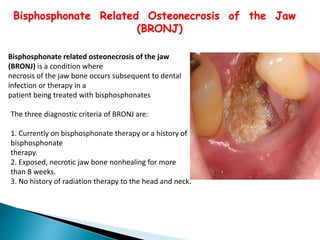 OSTEORADIONECROSIS &BRONJ-1 assignment.pptx