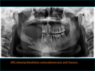 OSTEORADIONECROSIS &BRONJ-1 assignment.pptx