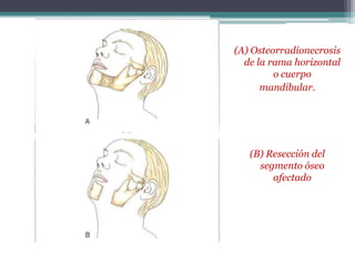 Osteorradionecrosis. | PPTX