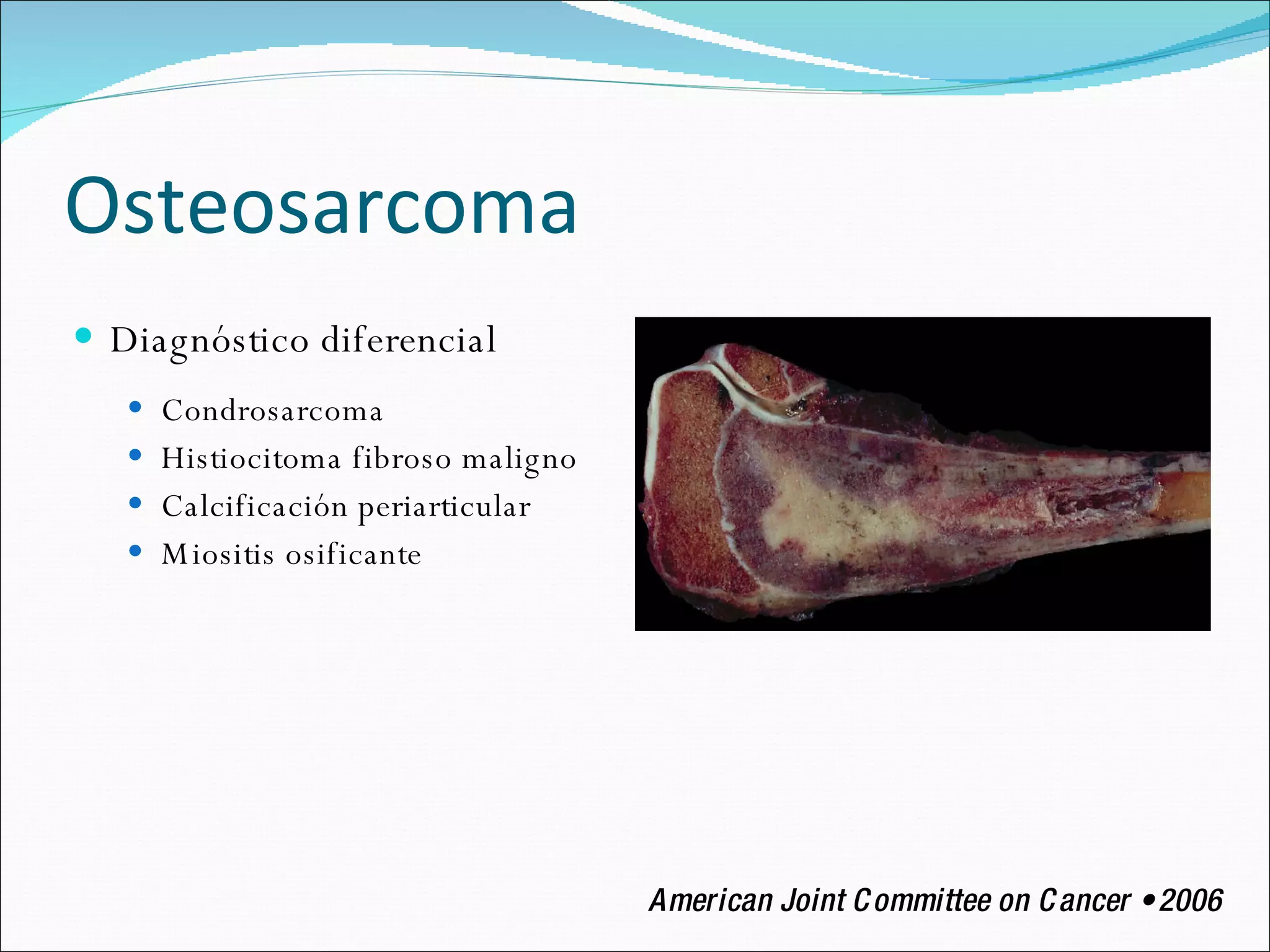 Osteosarcoma | PPT