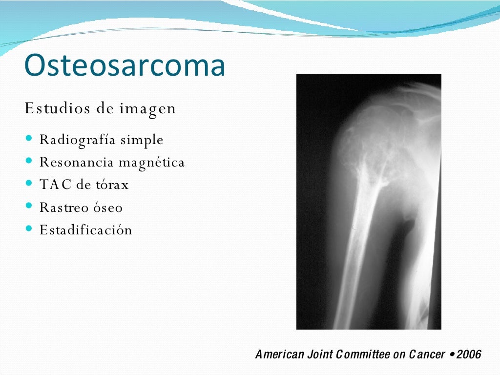 Osteosarcoma