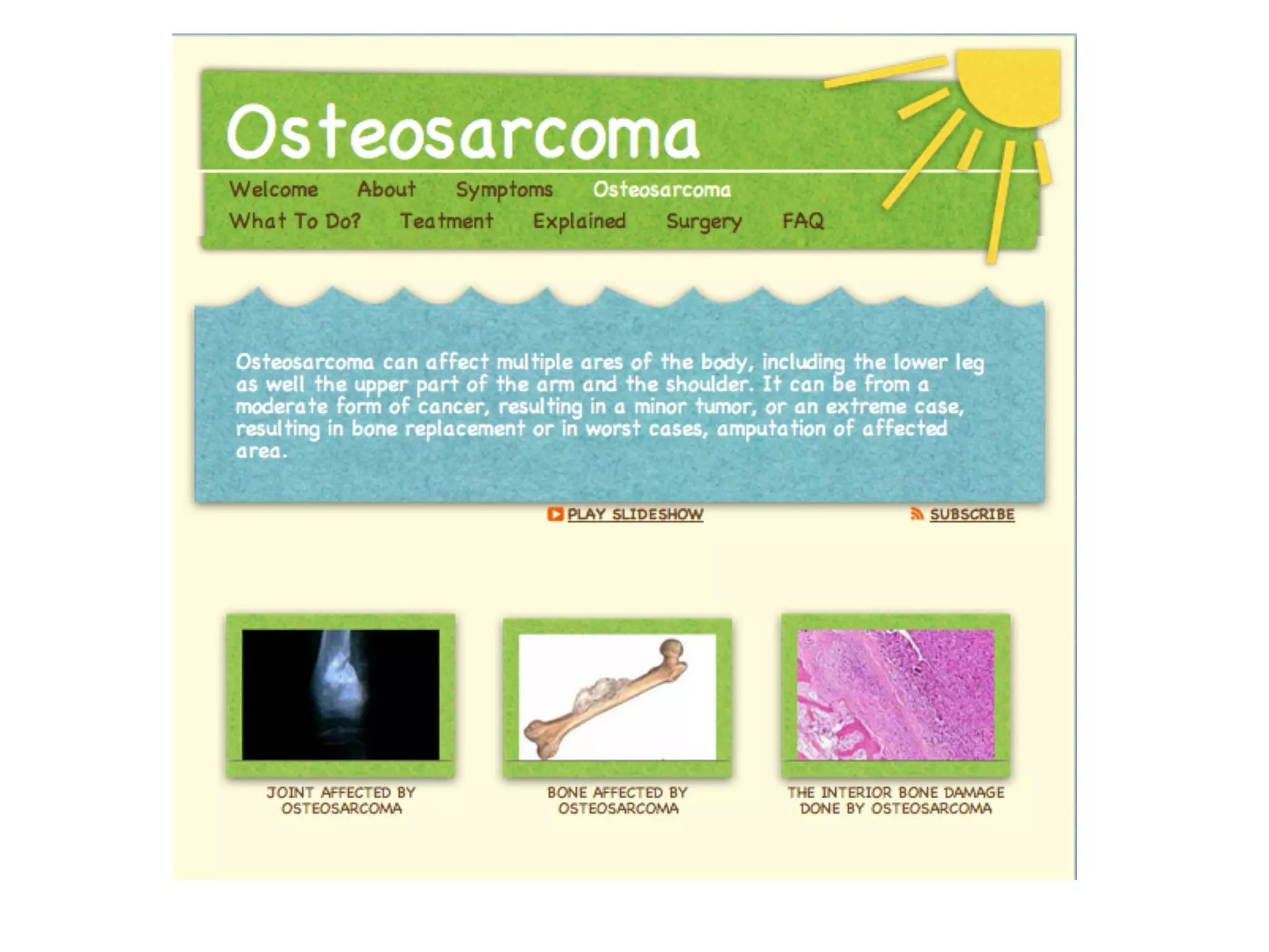 Osteosarcoma by Taylor Freeman | PPT