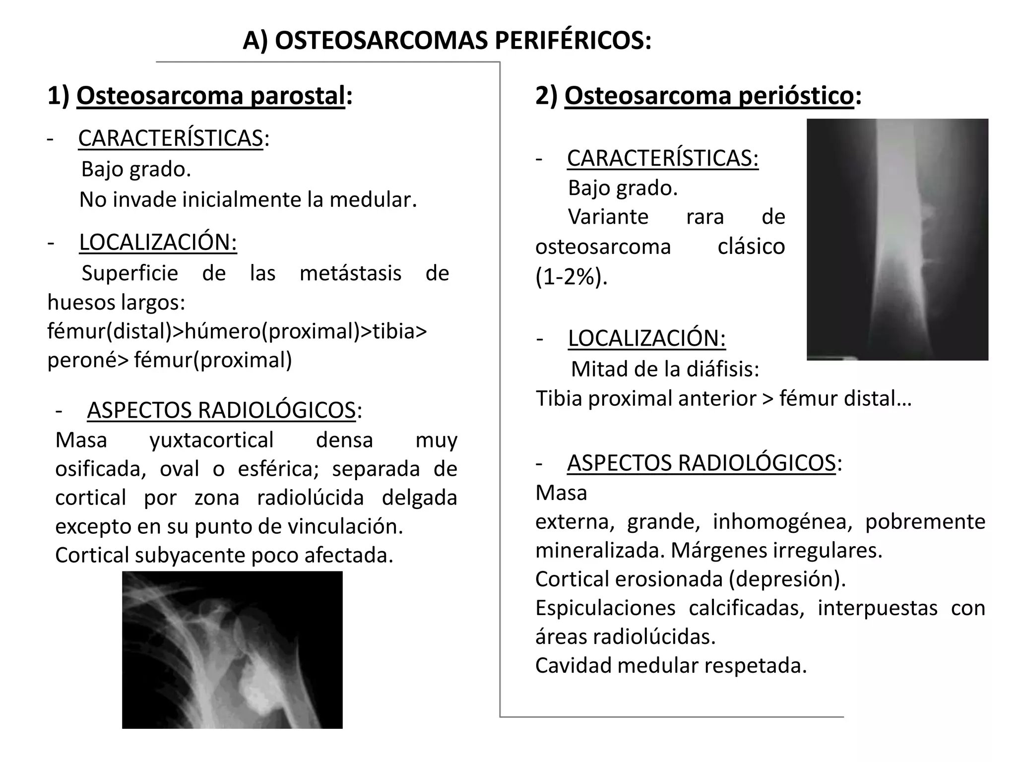 Osteosarcoma
