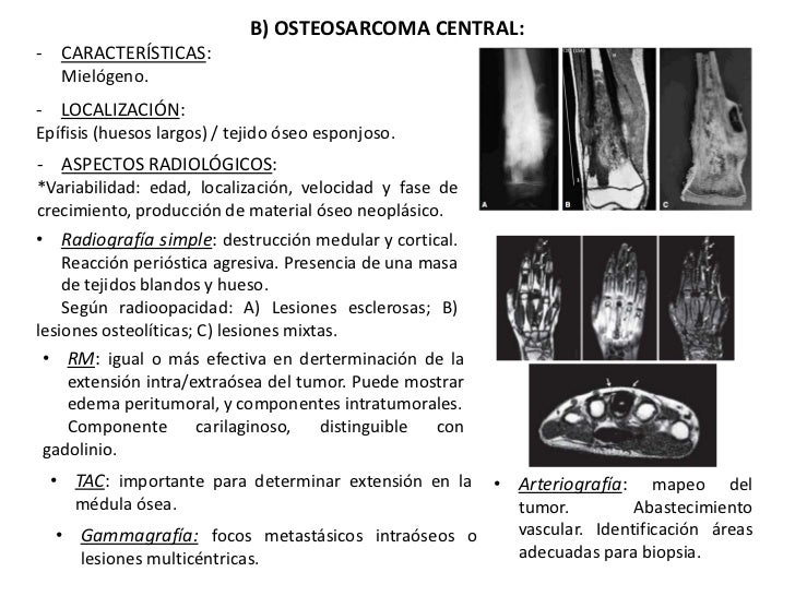 Osteosarcoma