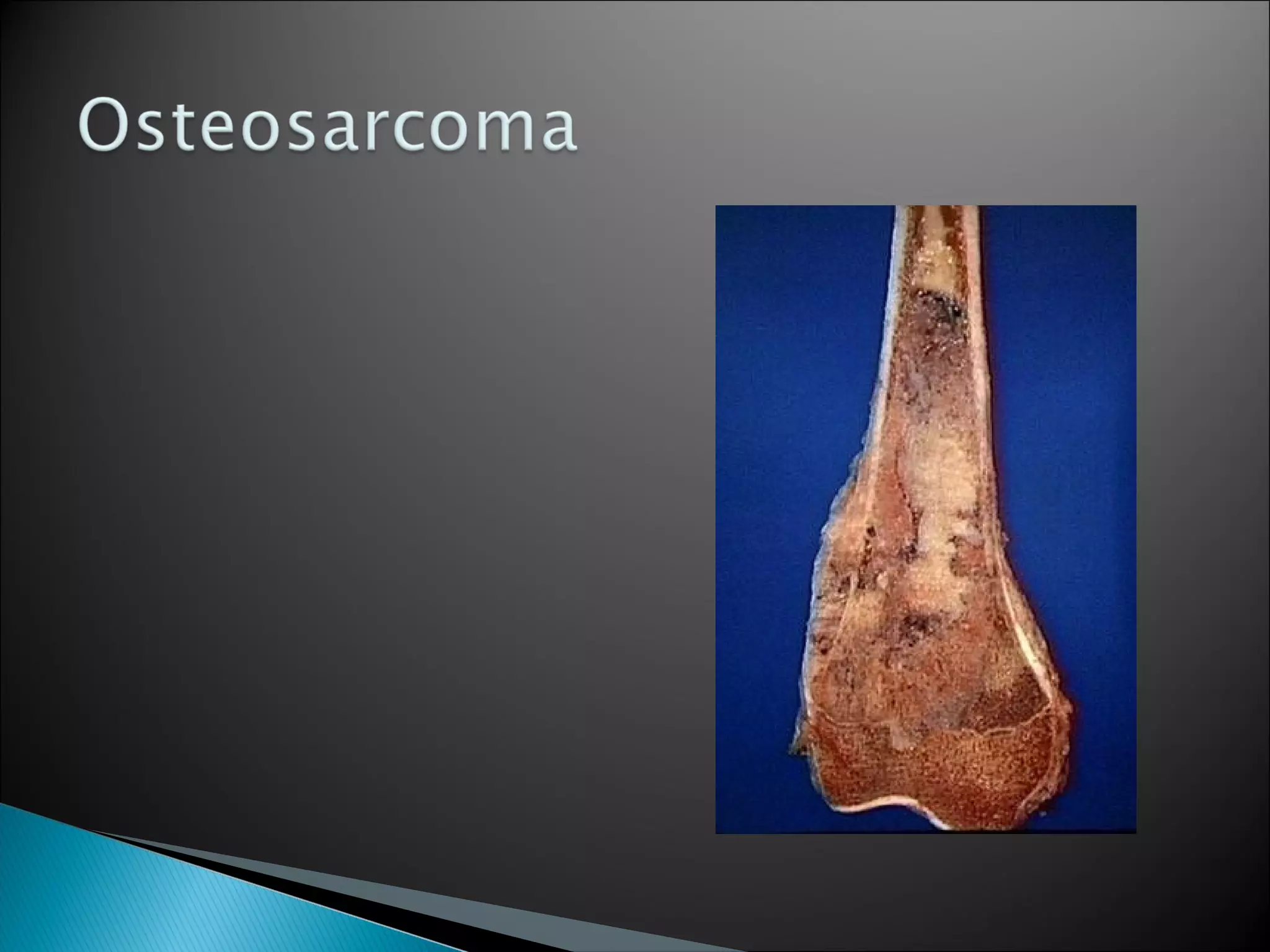Osteosarcoma | PPT