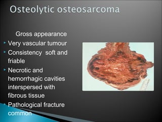 Osteosarcoma | PPT