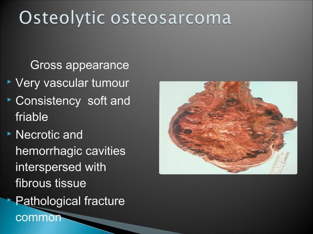 Osteosarcoma | PPT