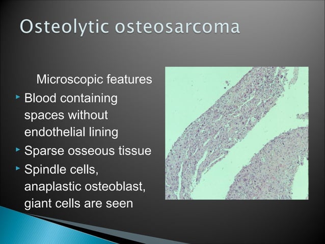 Osteosarcoma | PPT