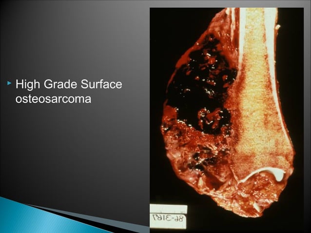 Osteosarcoma | PPT