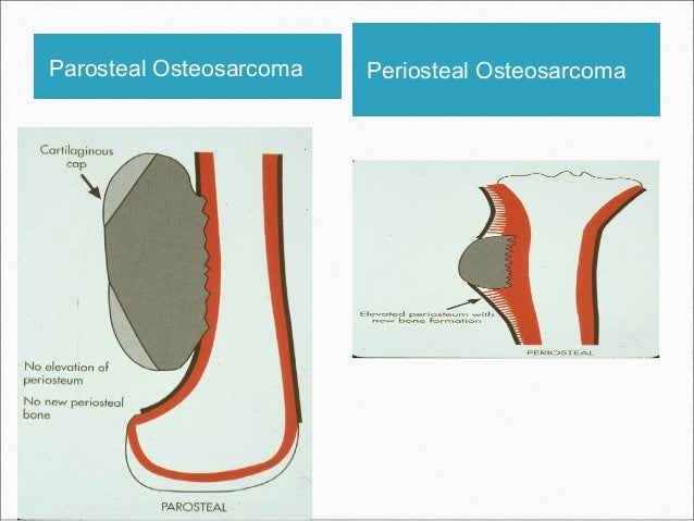 Osteosarcoma