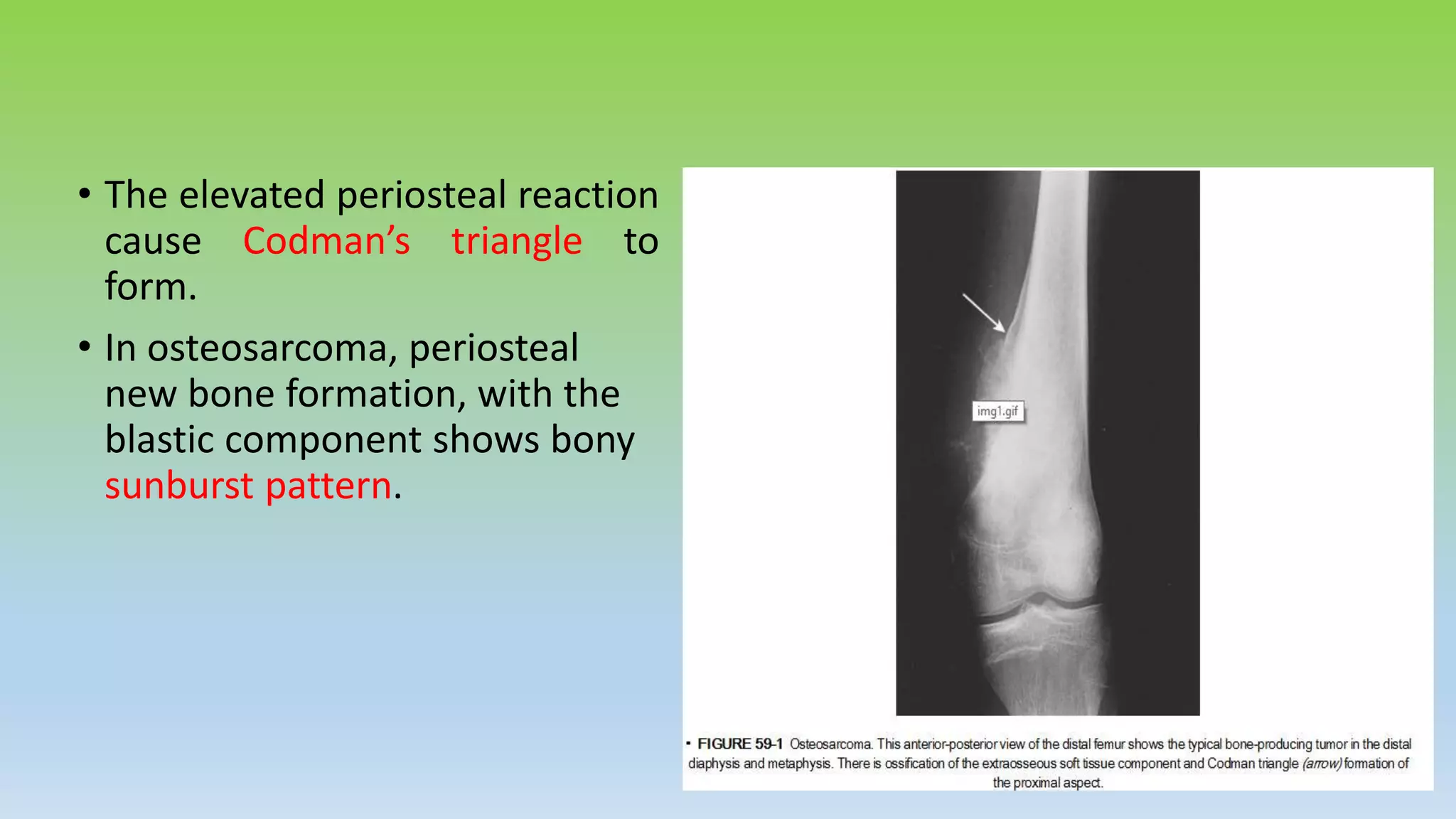 Osteosarcoma and Radiation therapy | PPTX