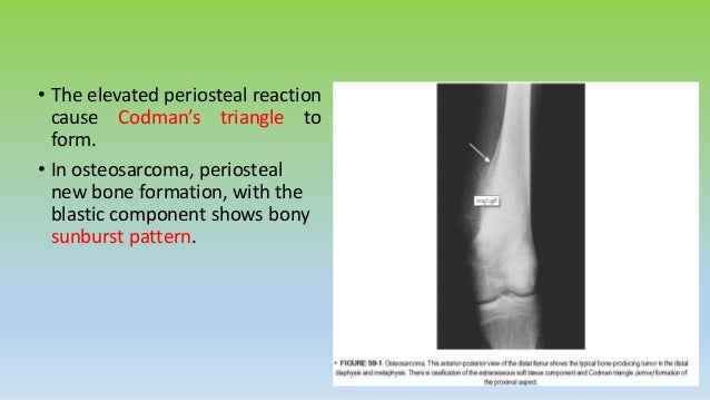Osteosarcoma and Radiation therapy
