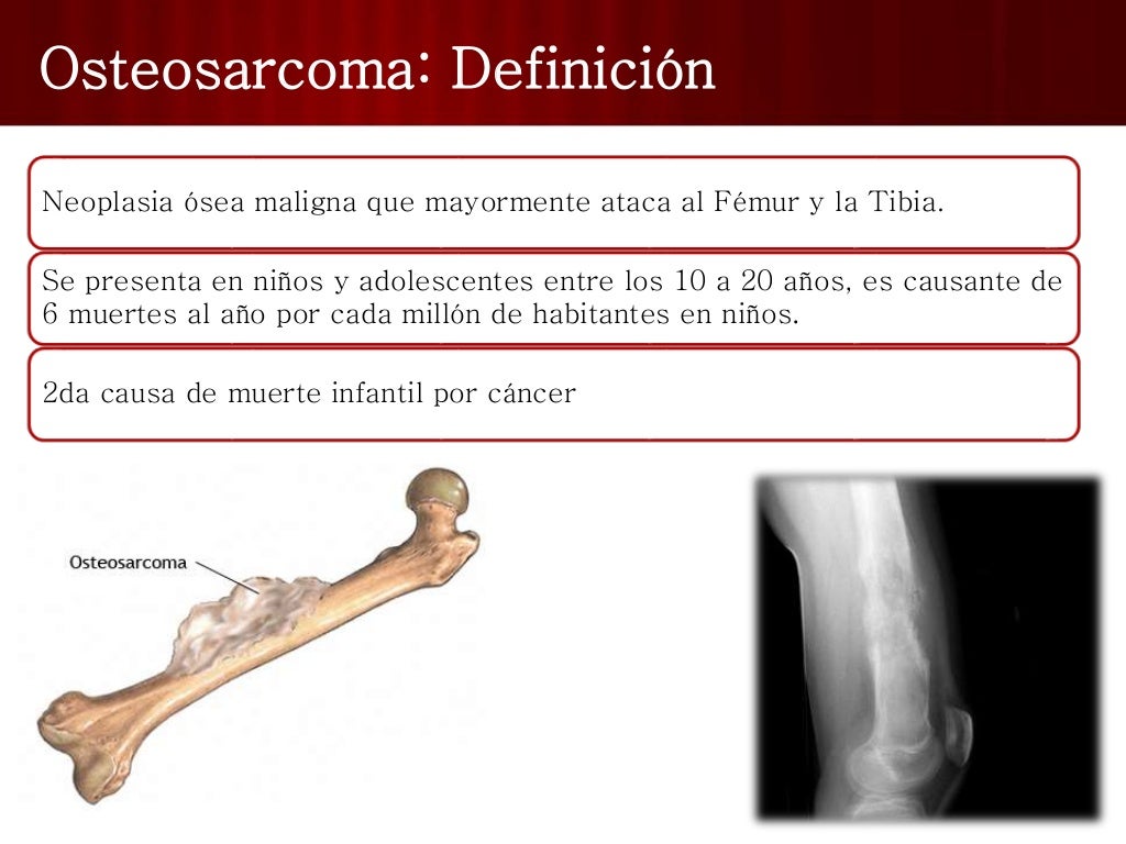 osteosarcoma