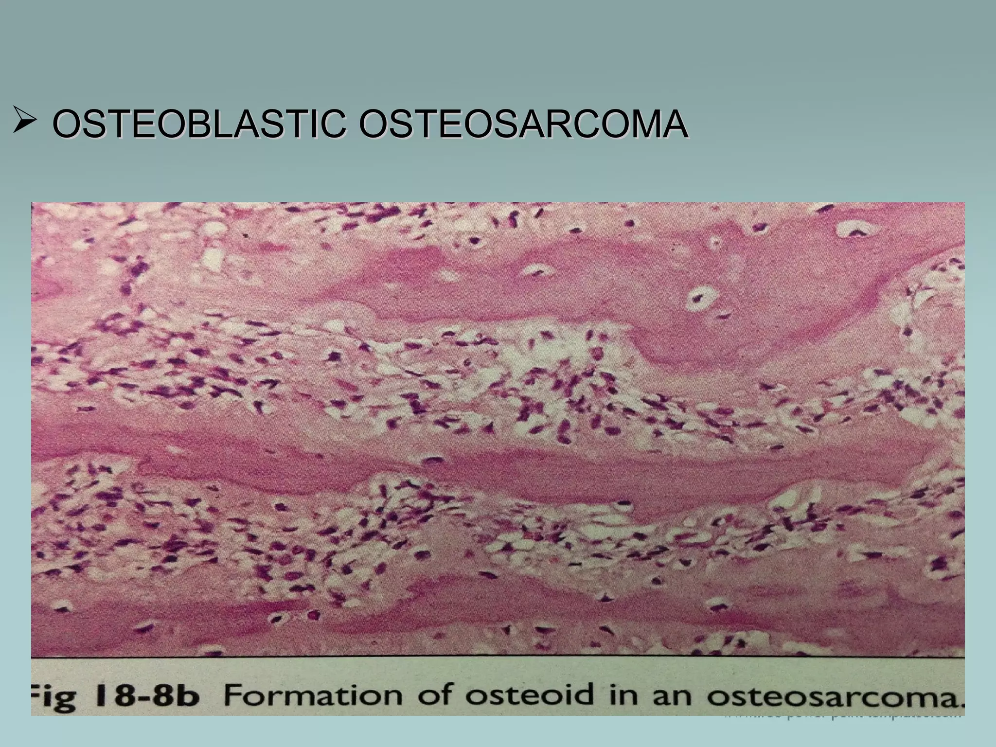 Osteosarcoma | PPT