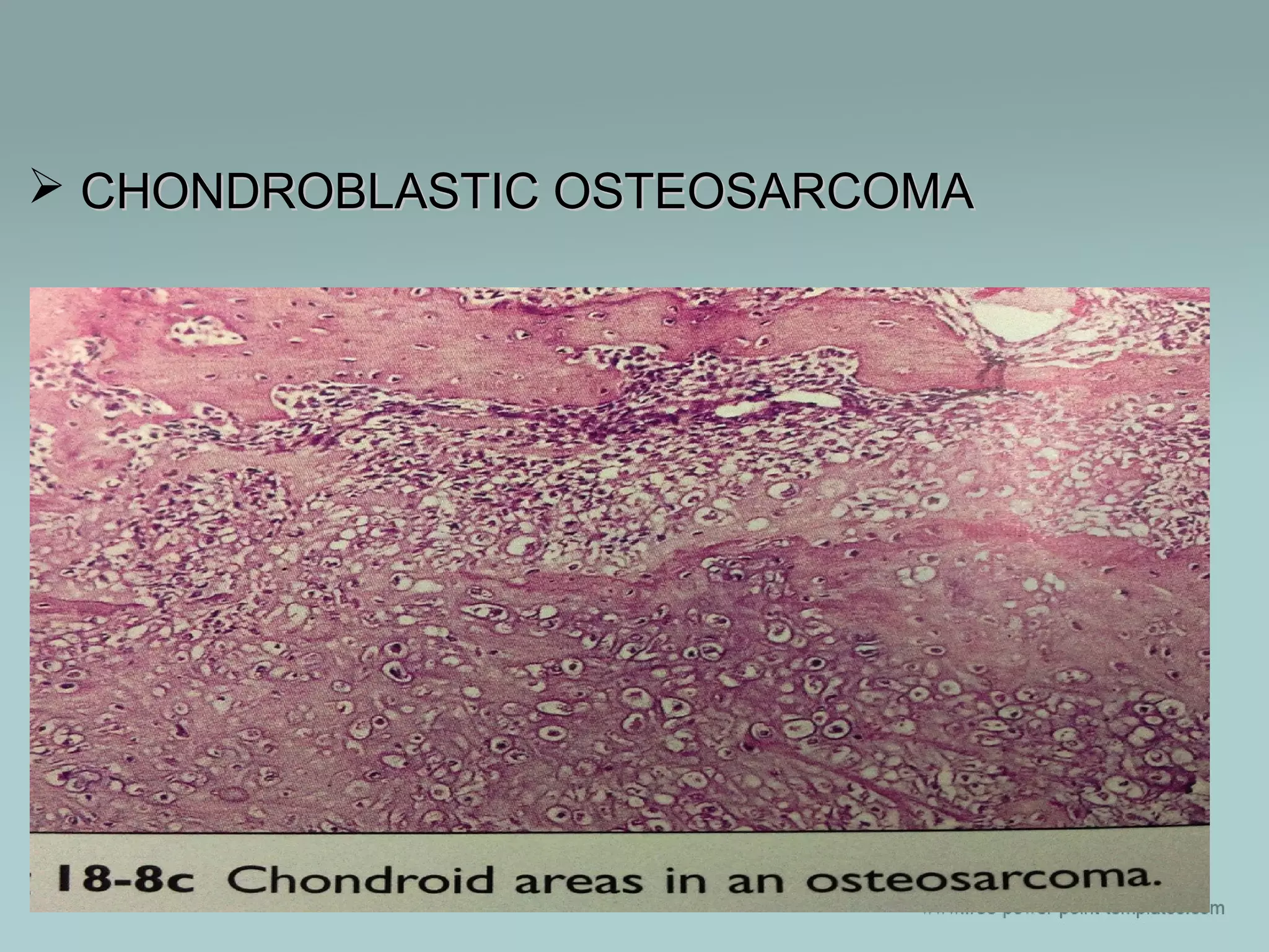 Osteosarcoma | PPT
