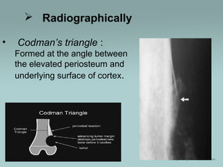 Osteosarcoma | PPT
