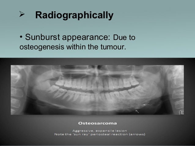 Osteosarcoma Sunburst Appearance