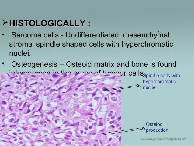 Osteosarcoma Histology Labeled