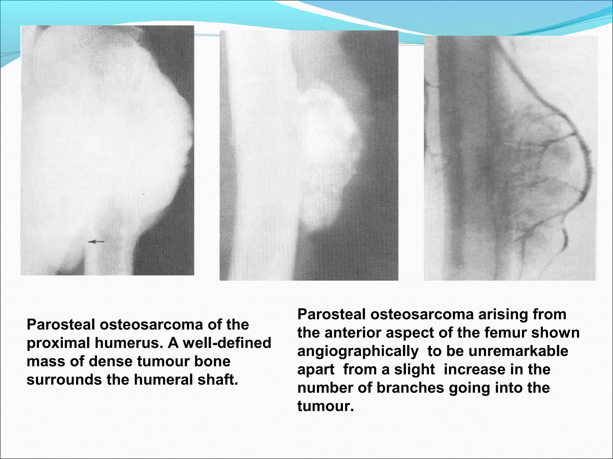 Osteosarcoma (knee joint) | PPT