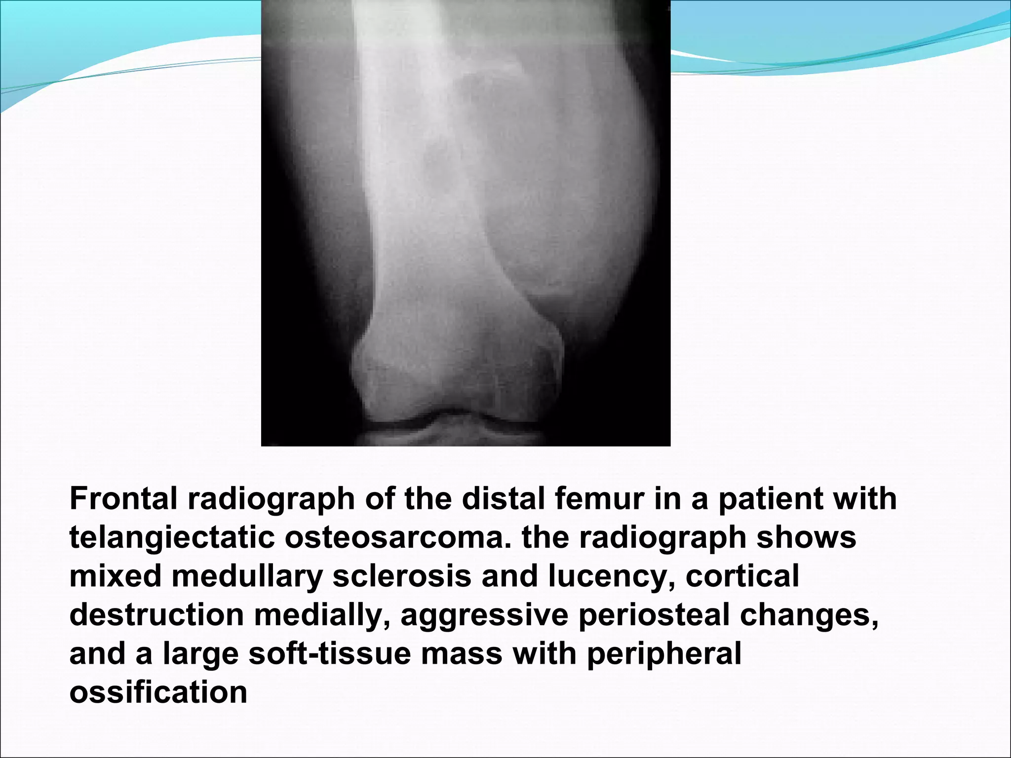 Osteosarcoma (knee joint) | PPT