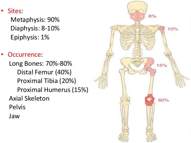 Osteosarcoma