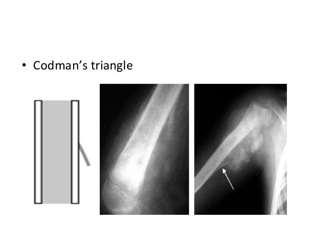 Osteogenic Sarcoma Codmans Triangle