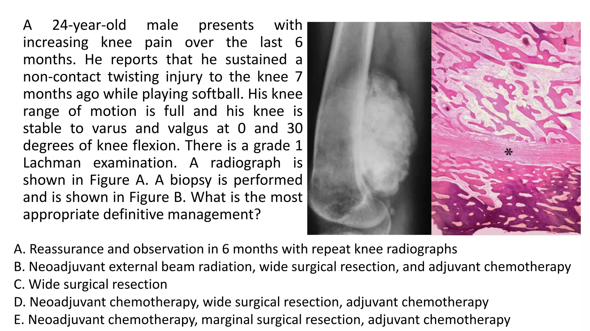 Osteosarcoma | PPTX
