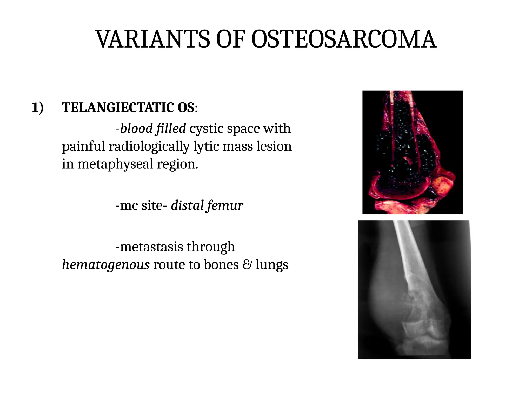 OSTEOSARCOMA MBBS UG CLASS DR RAKESH SINGHA.pptx