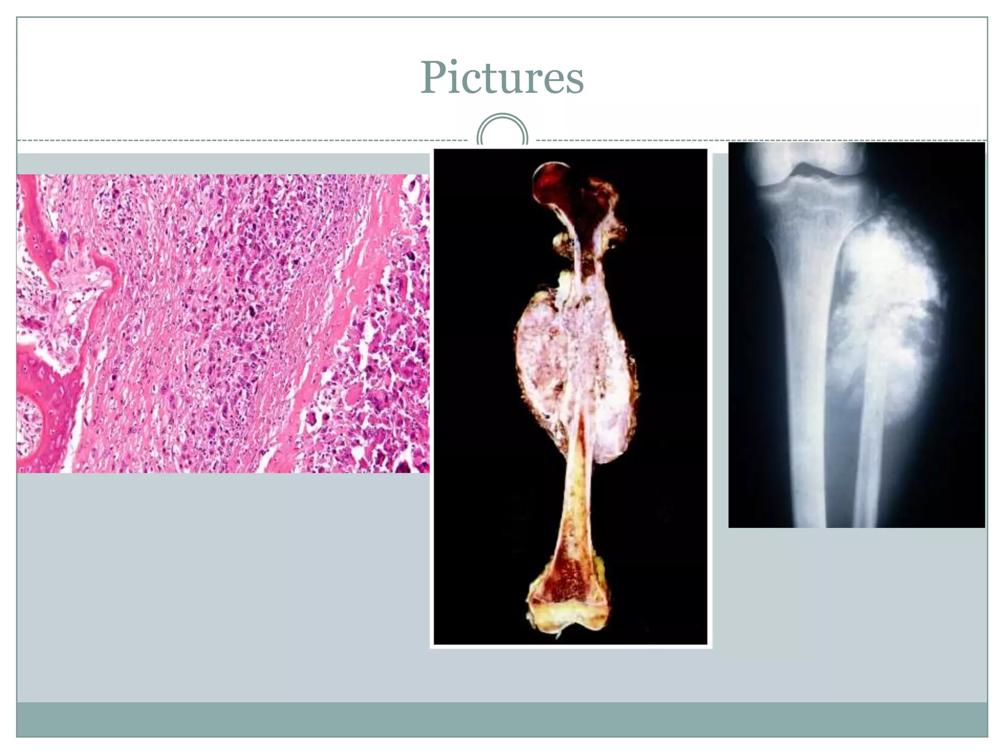 Osteosarcoma | PPTX | Bone and Joint Conditions | Diseases and Conditions